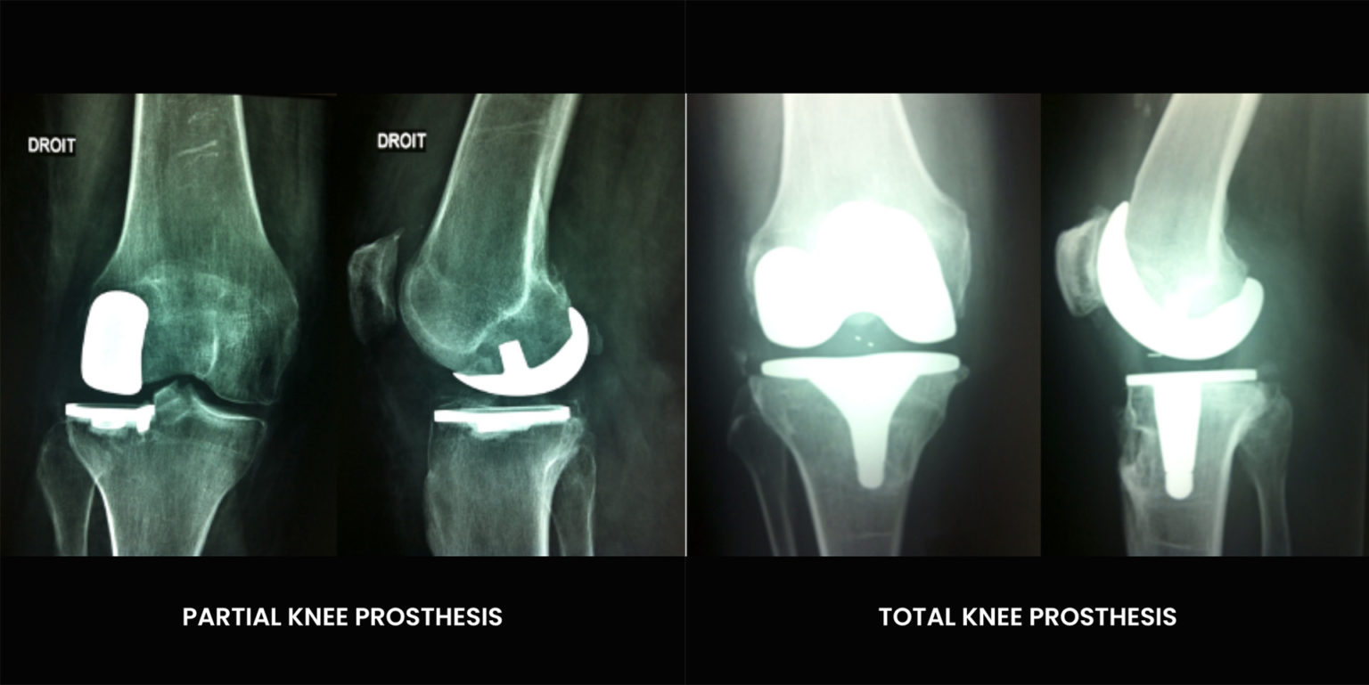 Revolutionizing Knee Rehabilitation with Exercise Therapy - David